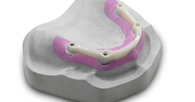 Bar prosthesis in dental technology | CADdent
